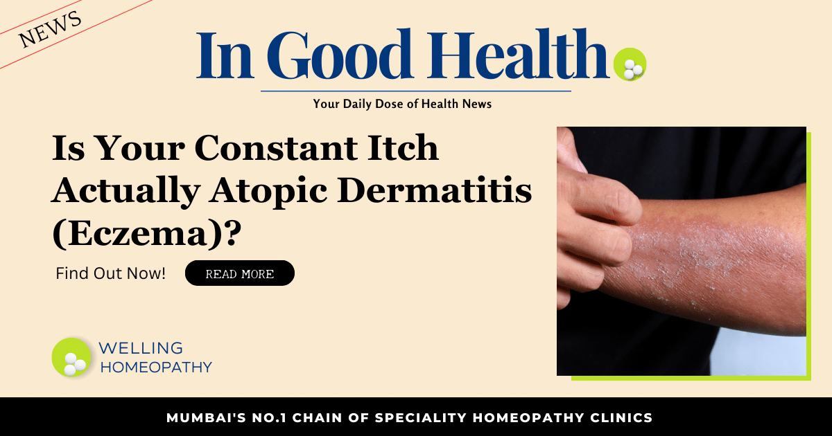 Constant Itching? Could Be Atopic Dermatitis (Eczema)